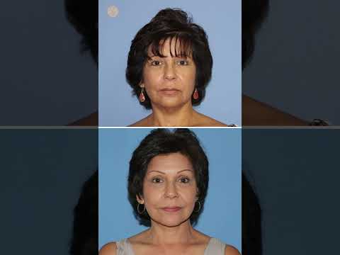 Great Vertical Lift Results | Dr. Kevin Sadati #antiaging #youth #brows #cosmetic #transformation