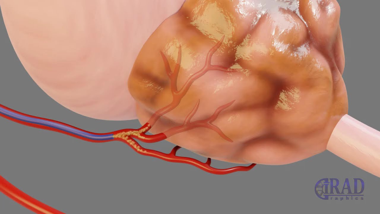 Prostate artery embolization for benign prostatic hyperplasia