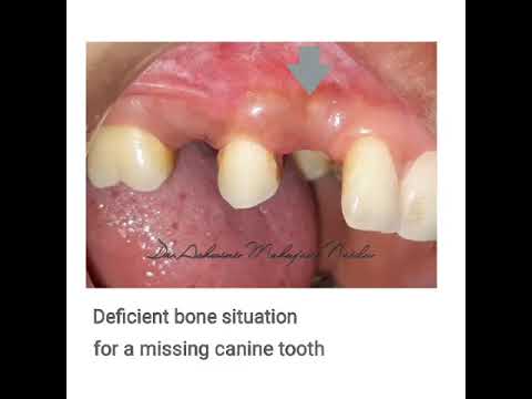 Implant placement (in deficient bone) with GBR (guided bone regeneration) #dentalimplant