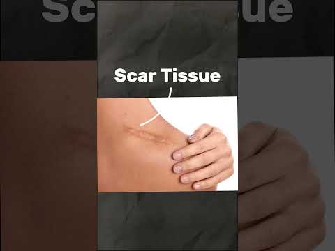 MPS Therapy Explained: Using Microcurrent for Muscle Relaxation & Scar Tissue Treatment