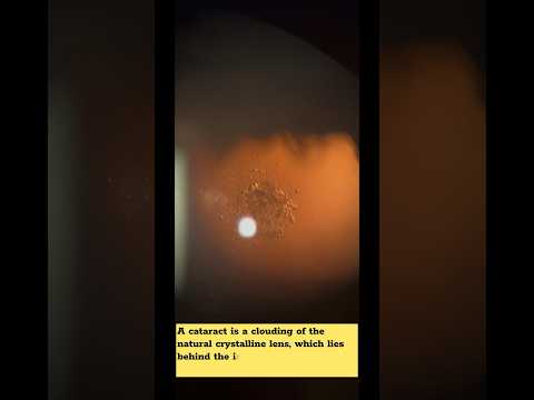 Cataract : Slit Lamp Examination👁️ #optometry #cataract #cataractdisease #ophthalmologists #youtube