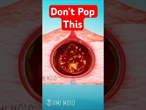 Why You Shouldn't Pop This! 😠Pilonidal Cyst Explained & Why It's Painful