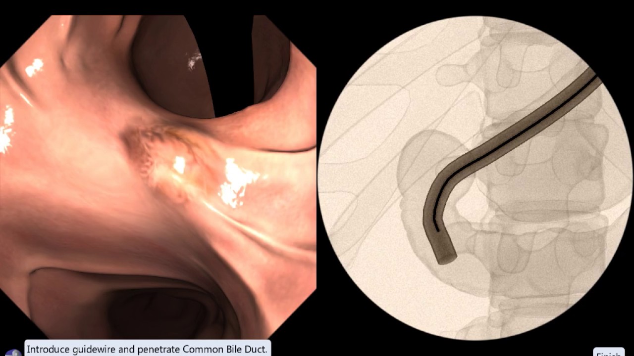 EndoSim Endoscopic Retrograde Cholangiopancreatography ( ERCP )