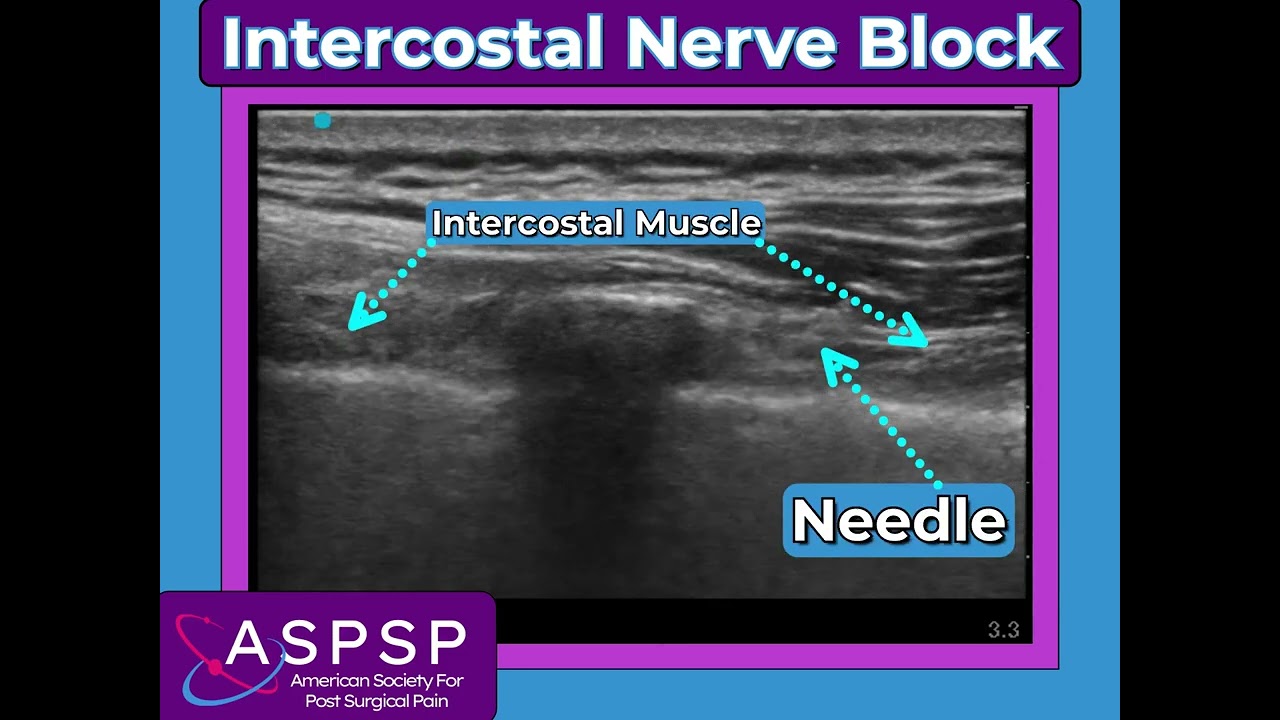 Intercostal Nerve Block
