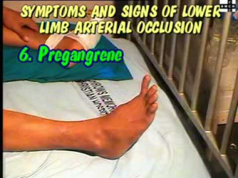 TAO and Laparoscopic Sympathectomy English