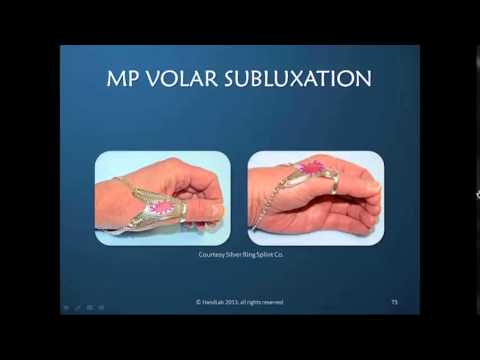 Thumb CMC Osteoarthritis: Optimal Orthotic Intervention for the MP & IP Joints Preview