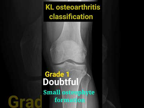 Stages of knee osteoarthritis|kellgren Lawrence grade knee OA #shorts #short #knee