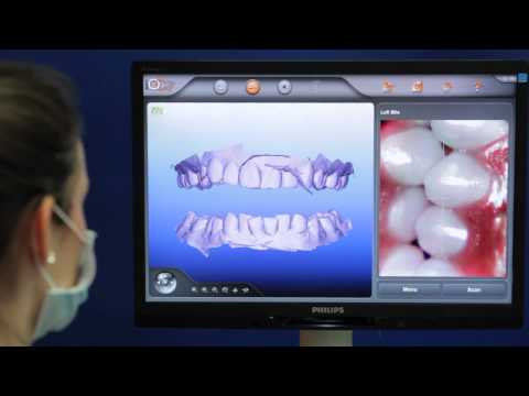 My Journey with Invisalign Braces: Power Ridges