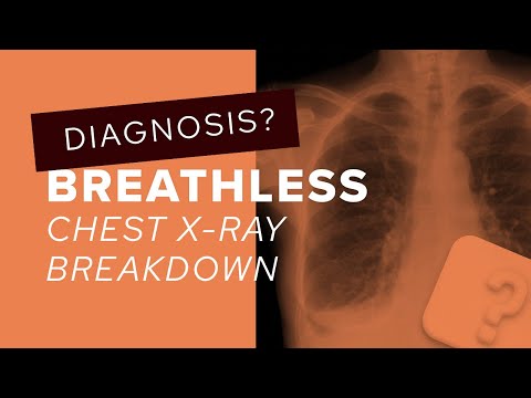 Chest X-Ray breakdown: assessing pericardial calcification