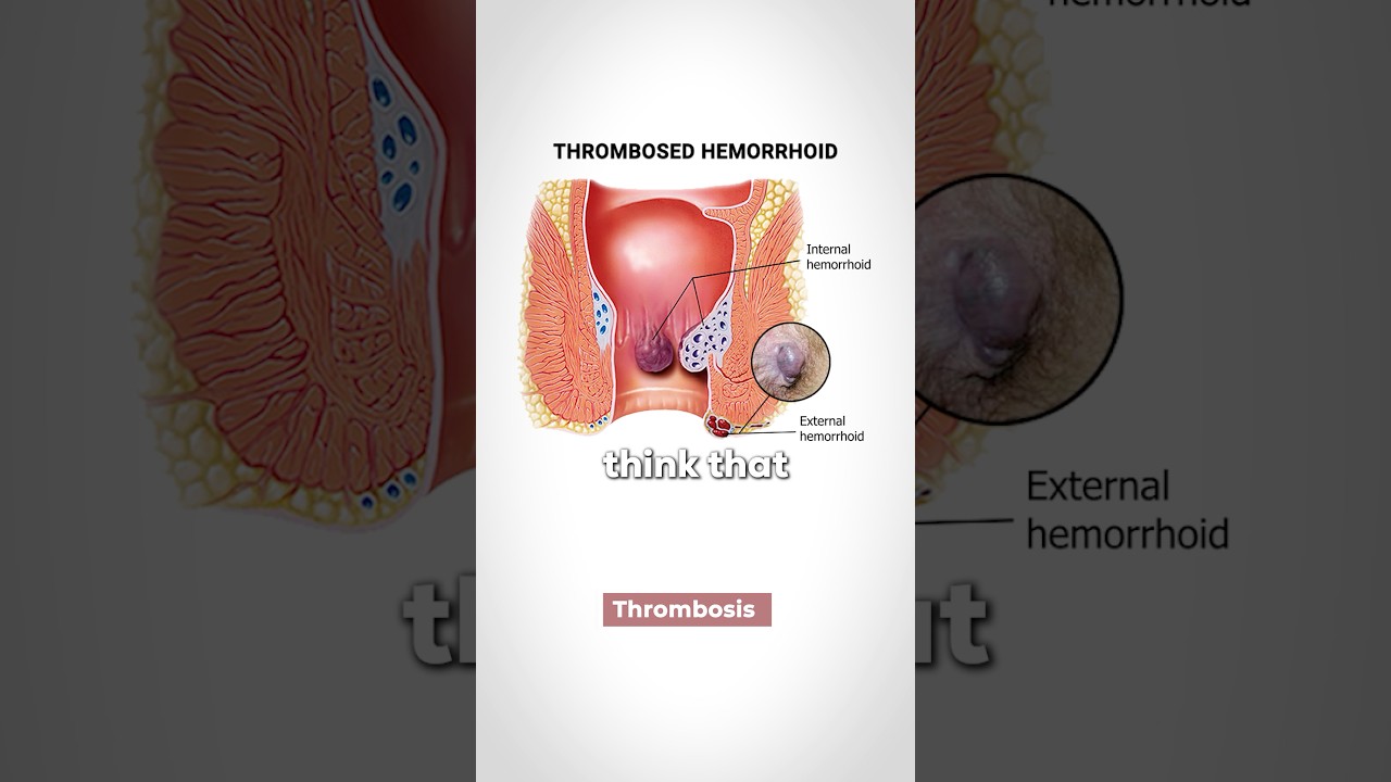 Hemorrhoids! What is the Cause?