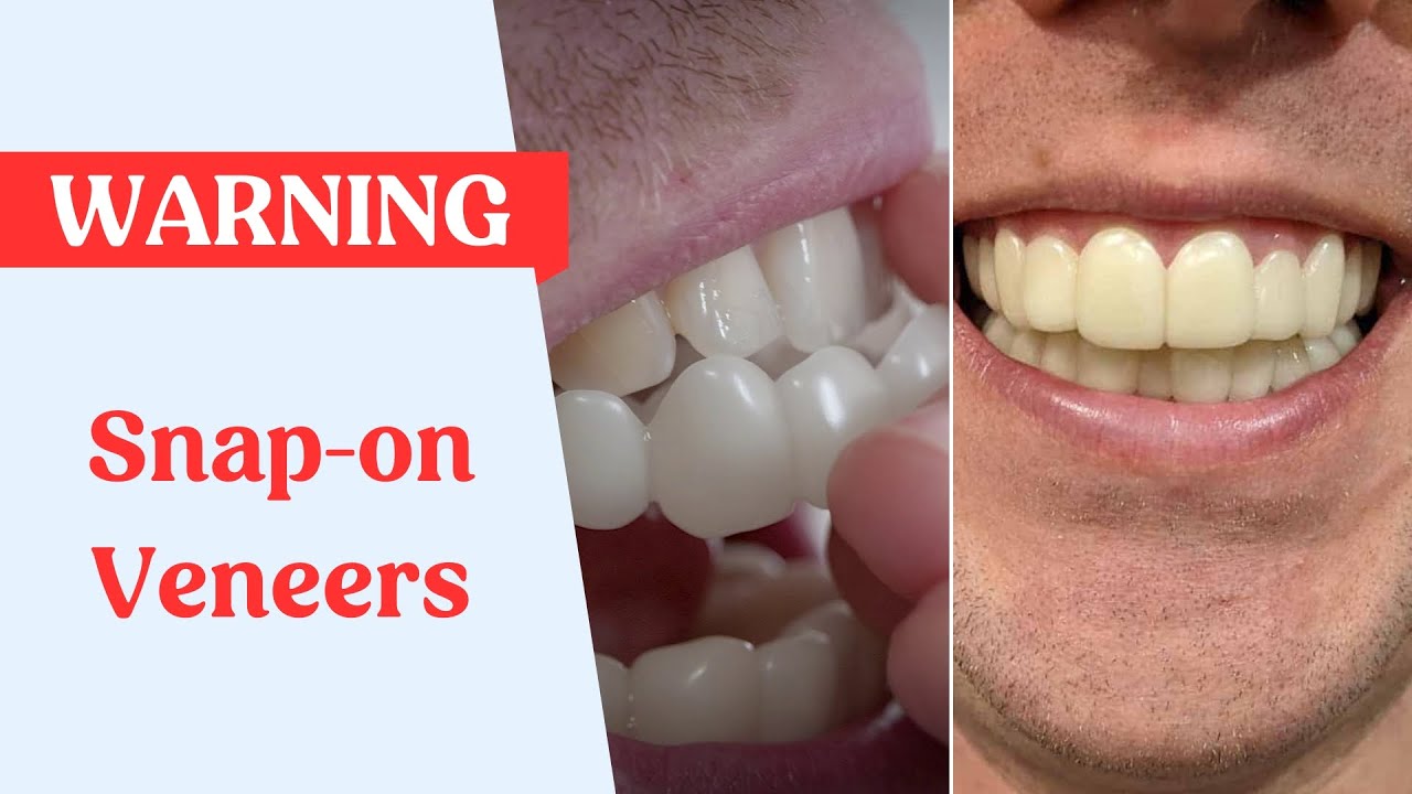 Snap On Veneers Warning