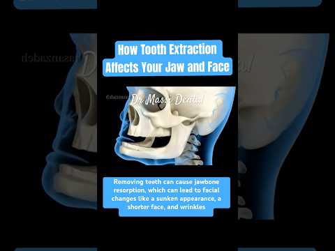 How Tooth Extraction Affects Your Jaw and Face