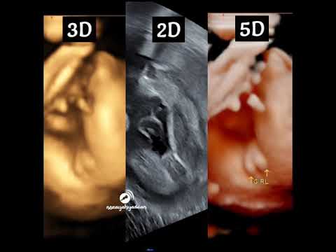 Fetal Gender