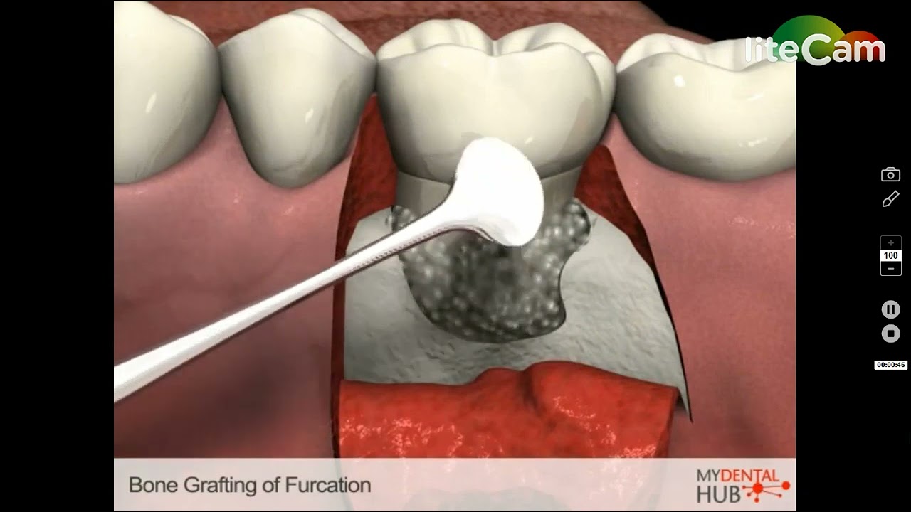 Guided Tissue Regeneration with Bone Grafting