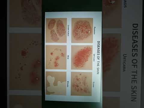 Fungal Infection | Prickly Heat | Itching | Skin Rash | Skin Irritation - Easy solution 100% Working