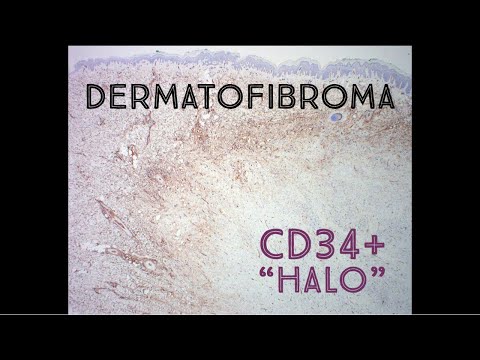 Beware the CD34 Halo in dermatofibroma! (it's NOT DFSP!) (pathology dermpath dermatology)
