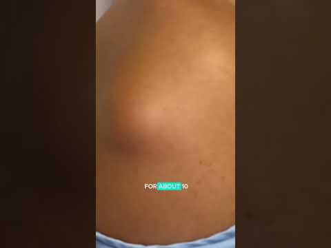 15-YEAR-OLD LIPOMA REMOVAL - DR. TANVEER JANJUA - NEW JERSEY