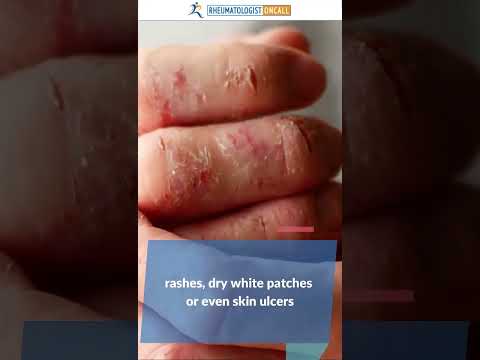 Skin Changes in Dermatomyositis and Vasculitis