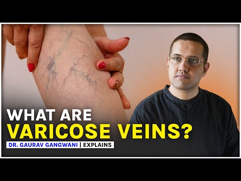 What is Varicose Veins? || Dr. Gaurav Gangwani (Interventional Radiologist) #Shorts