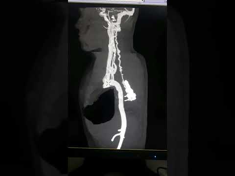 CTA NECK VESSELS. #neck #angiogram #neckpain #neckangiogram #ctscan