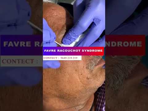 Things You Most Likely Didn't Know About Favre Racouchot Syndrome. #favre_racouchot_syndrome #shorts