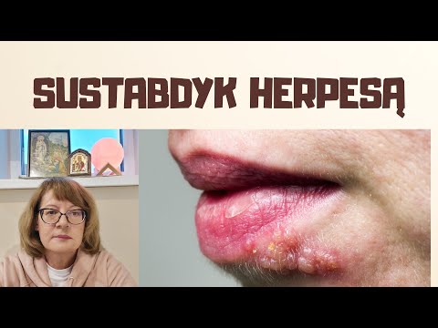Sustabdyk Herpesą