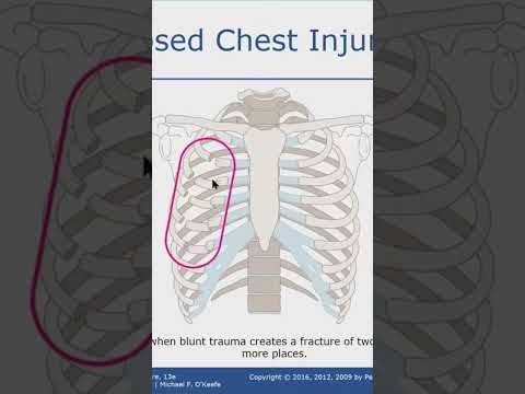 Flail Chest - Chest Injury #anatomy #doctor #science #biology #physiotherapy #emergency #emt #nremt
