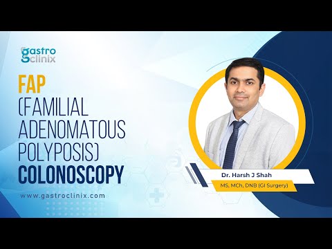 FAP (Familial Adenomatous Polyposis)- Colonoscopy by Dr. Harsh Shah