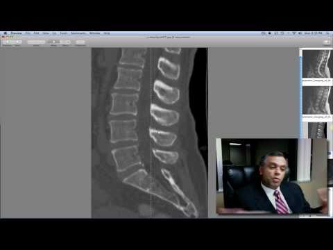Normal Lumbar Anatomy. Low Back Anatomy