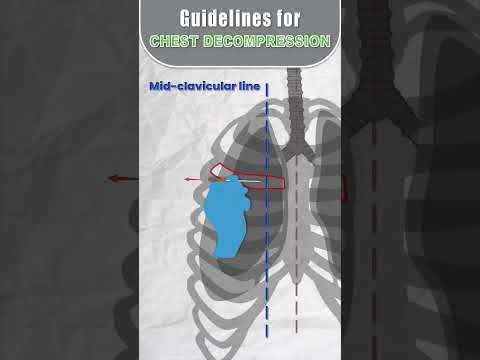 Chest Decompression guidelines #usmle #internalmedicine #chest