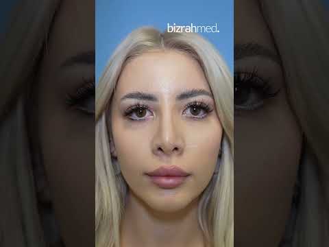 Nose Job Patient Testimonial | Nose Job Before & After Result : Dr. Bashar Bizrah/ London/Dubai