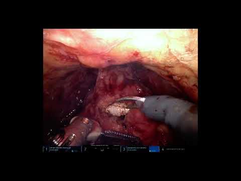 Robotic en bloc resection sparing the bladder and anus for locally advanced low rectal cancer