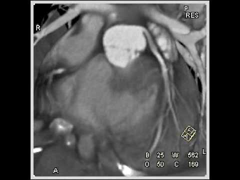 Cardiac: diseased aortic valve with aortic valvular stenosis (1 of 10)