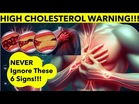Warning Signs You Can’t Ignore: Top 6 Signs of High Cholesterol Levels Revealed! High LDL