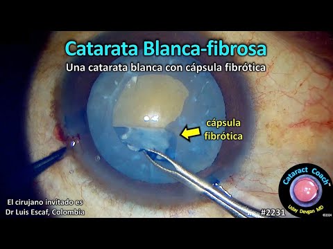 CataractCoachâ„¢ 2231: catarata blanca fibrosa