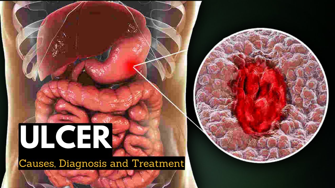 Ulcer, Causes, Signs and Symptoms, Diagnosis and Treatment.