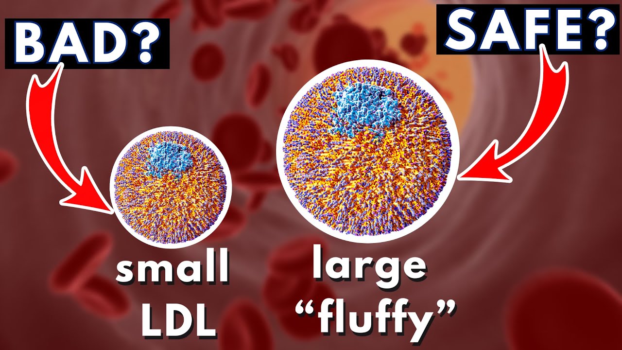 LDL size and Heart Disease (small dense vs large 