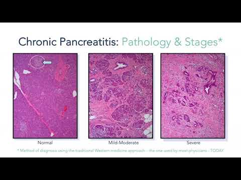 Genetics & Pancreatitis: Facts and Fiction