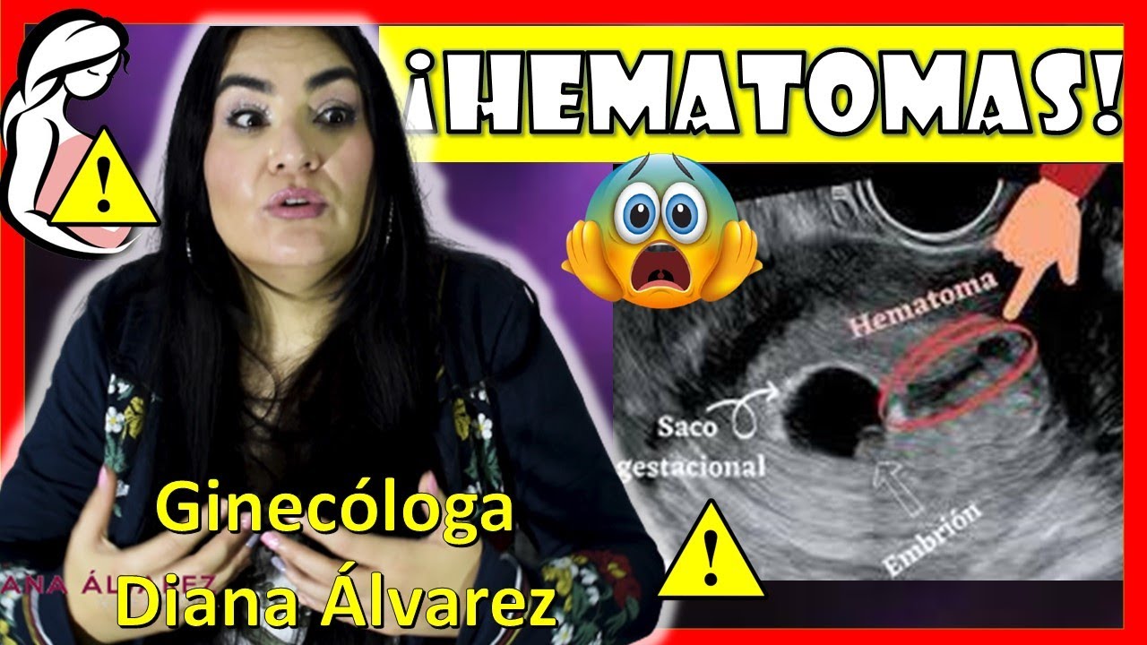 HEMaTOMAs en el EMBARAZO, SANGRaDOs PRiMER y SEGuNDO TRiMESTRE, por GINECOLOGA DIANA ALVAREZ