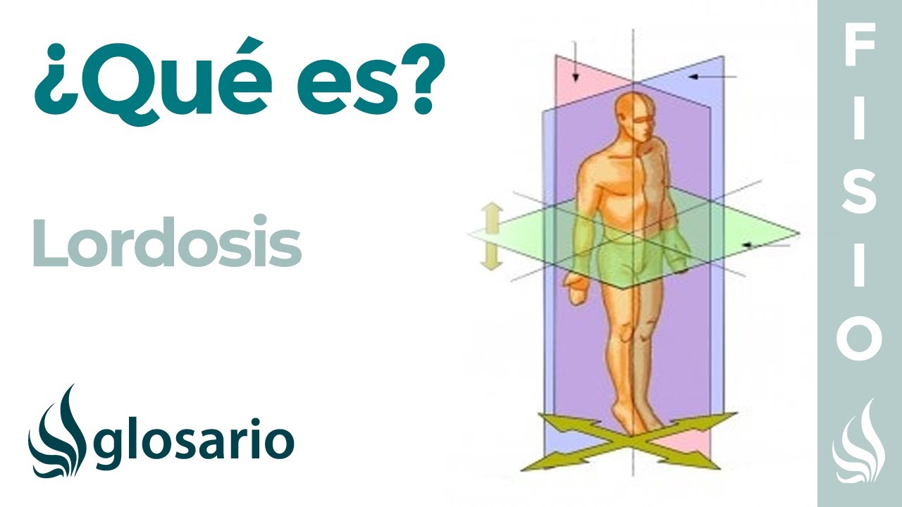 LORDOSIS | Qué es, por qué se produce, cuáles son sus síntomas y a quién afecta