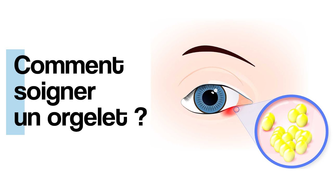 Comment soigner un orgelet ?