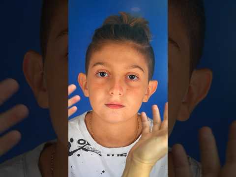 Experience and immediate result of Mason's #otoplasty, to correct his #prominent ears