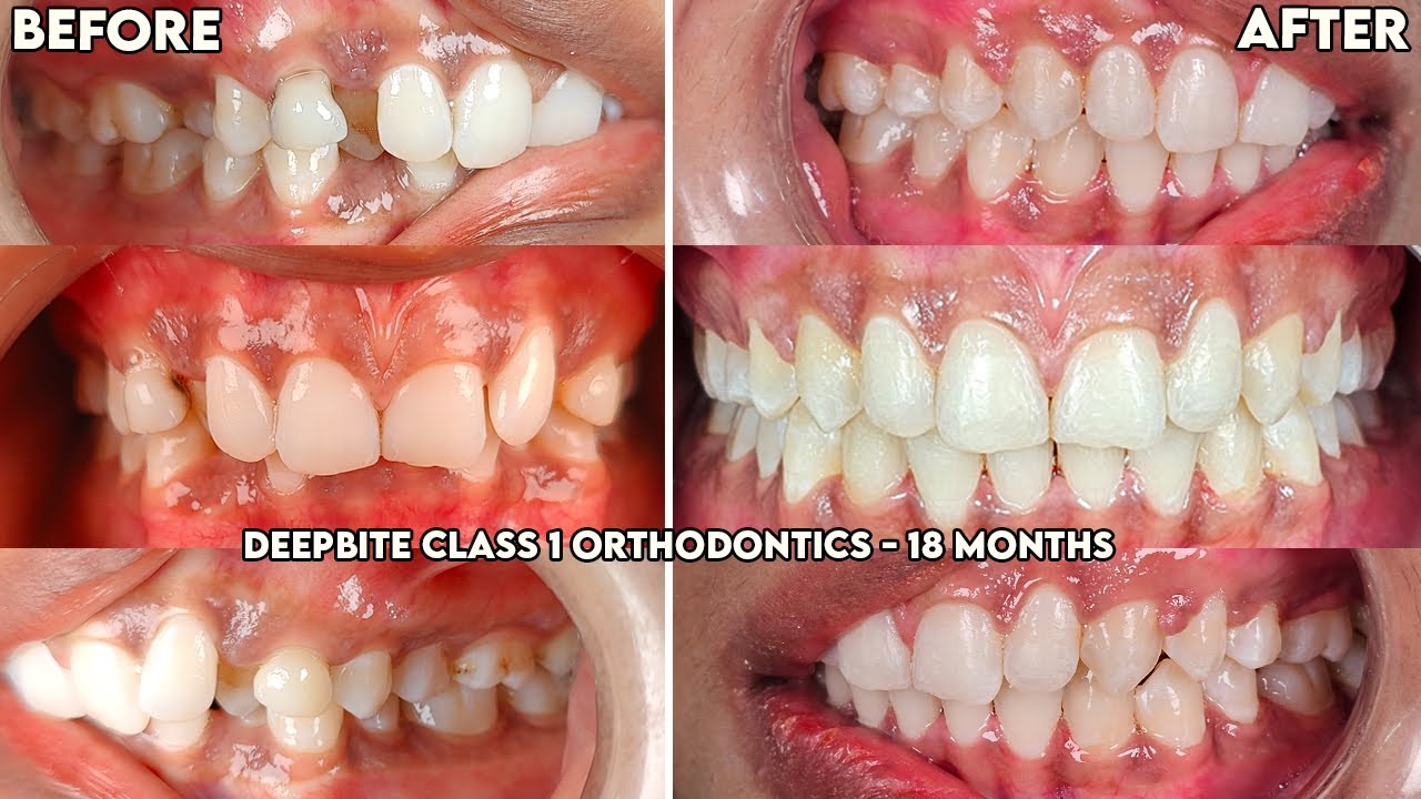 Deepbite Class 1 Orthodontics Case  Discussion - 18 Months