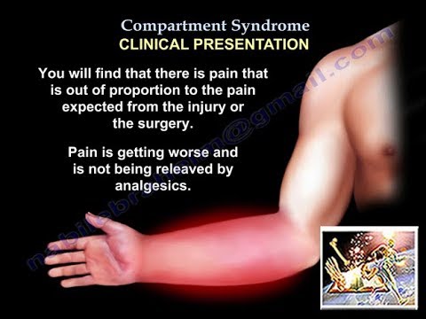 Compartment Syndrome - Everything You Need To Know - Dr. Nabil Ebraheim
