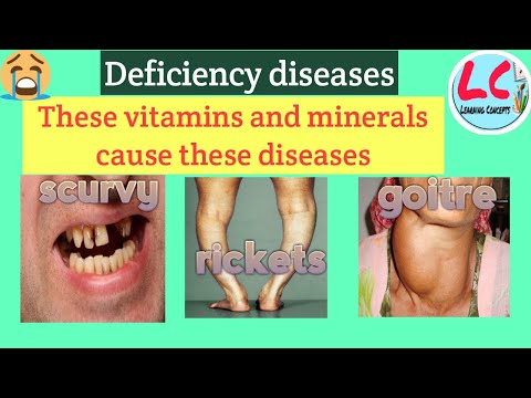 Deficiency Diseases | Science | Class 6 | in Hindi |