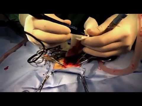 Spinal Surgery