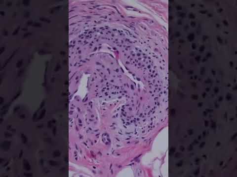 Normal glomus body (Sucquet-Hoyer canal) under the microscope. #Pathology #dermatology #skin #usmle