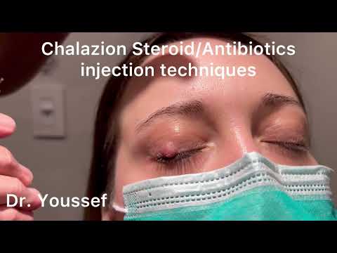 Chalazion Easiest and simplest Treatment with Steroid and Antibiotic Injections