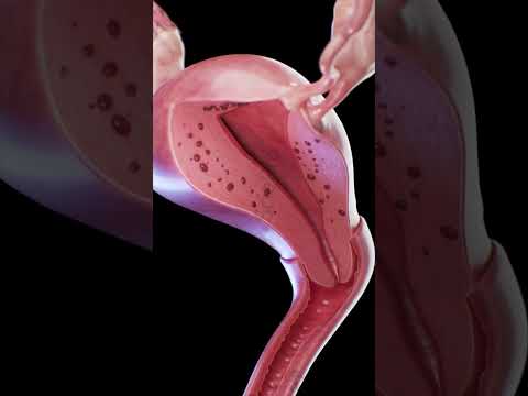 Adenomyosis | 3D Uterus Animation