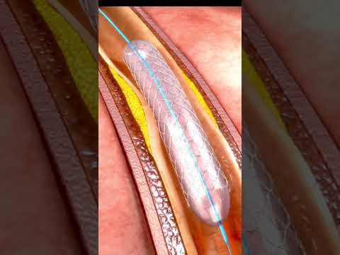 कैसे होती है हार्ट के एंजियोप्लास्टी 3D Animation: Angioplasty Surgery Explained in Detail!